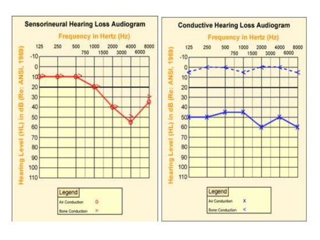 Csom, cholesteatoma | PPTX | Ear, Nose and Throat Conditions | Diseases ...