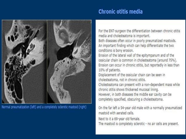 Csom, cholesteatoma | PPTX | Ear, Nose and Throat Conditions | Diseases ...