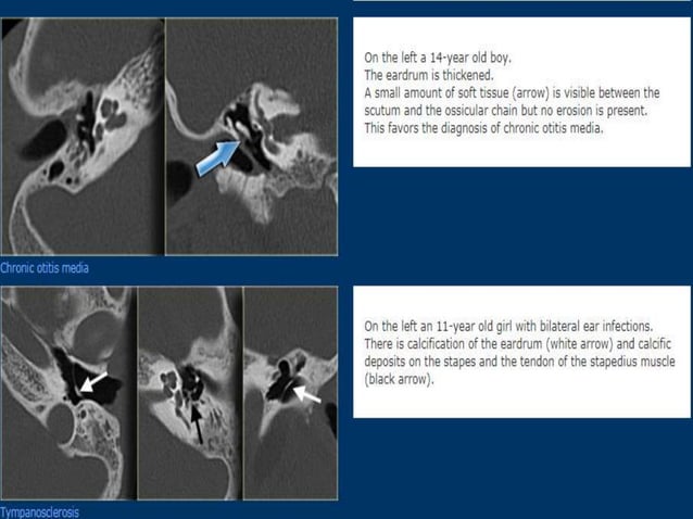 Csom, cholesteatoma | PPTX | Ear, Nose and Throat Conditions | Diseases ...