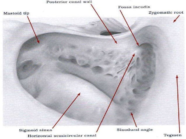 Csom, cholesteatoma | PPTX | Ear, Nose and Throat Conditions | Diseases ...
