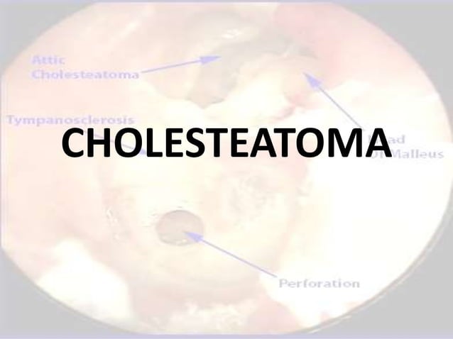 Csom, cholesteatoma | PPTX | Ear, Nose and Throat Conditions | Diseases ...