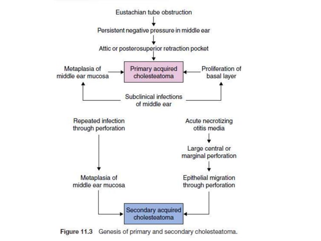 Csom, cholesteatoma | PPTX | Ear, Nose and Throat Conditions | Diseases ...