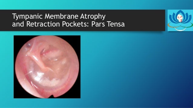 Csom in children challenges in management