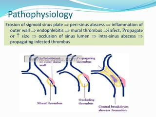 Otitis media intracranial complications | PPTX