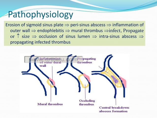 Otitis media intracranial complications | PPTX