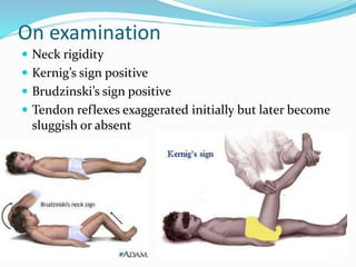 Otitis media intracranial complications | PPTX