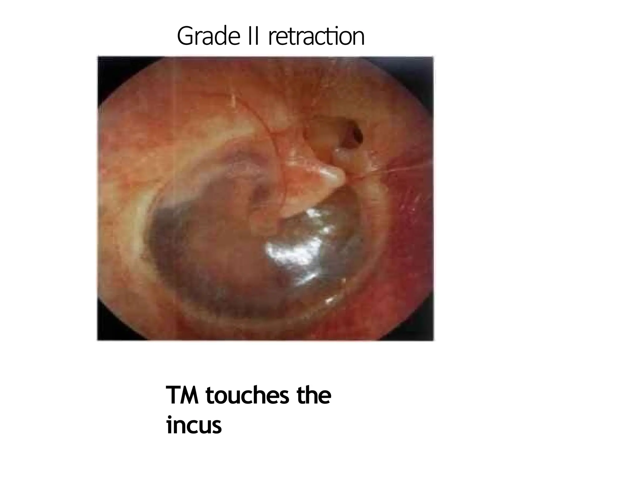 CSOM (both) ppt both types of CSOM tubotympanic | PPTX