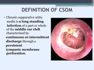 CSOM_chronic suppurative otitis media pptx | PPTX