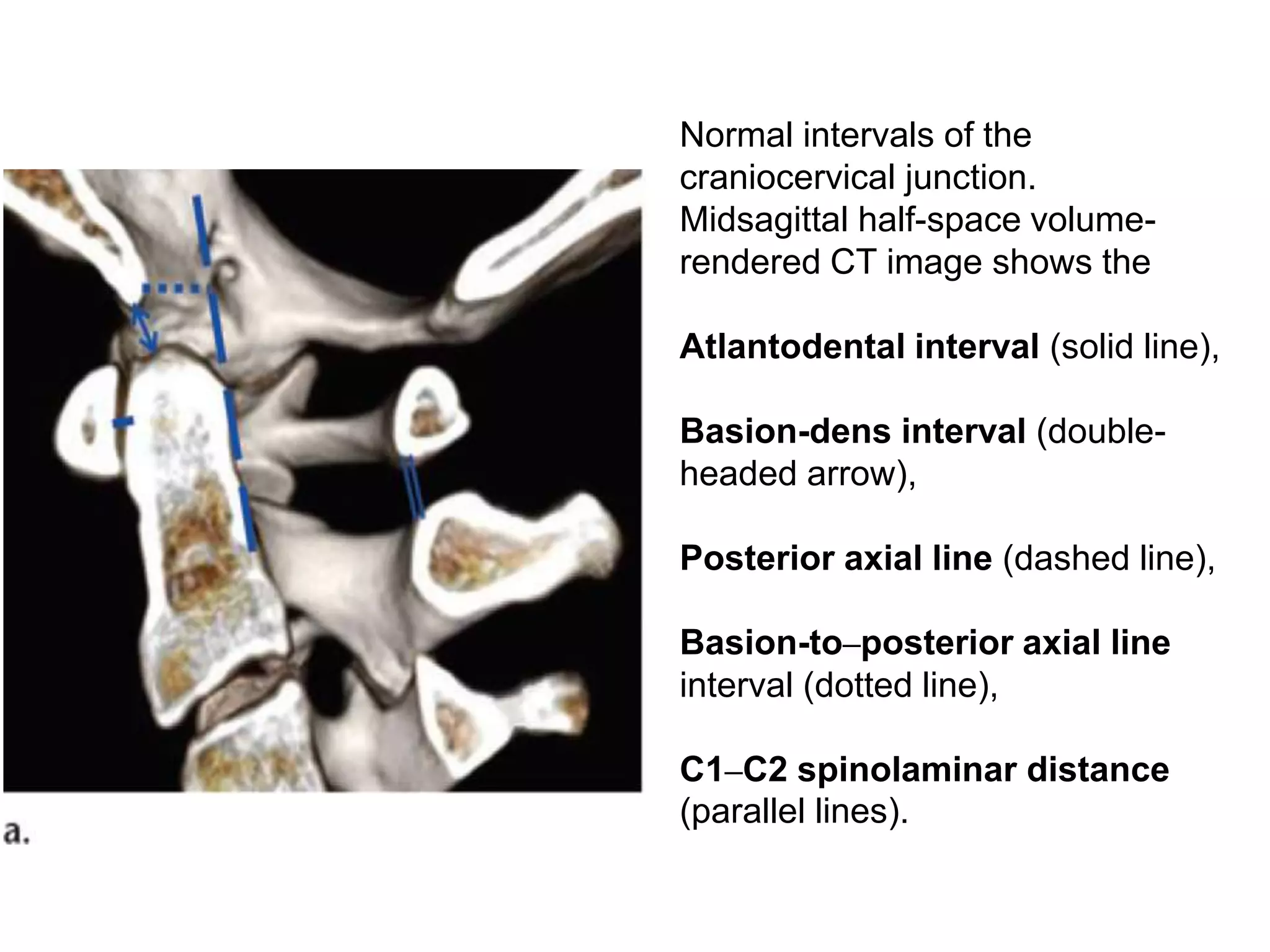 CT Cervical Spine | PPTX