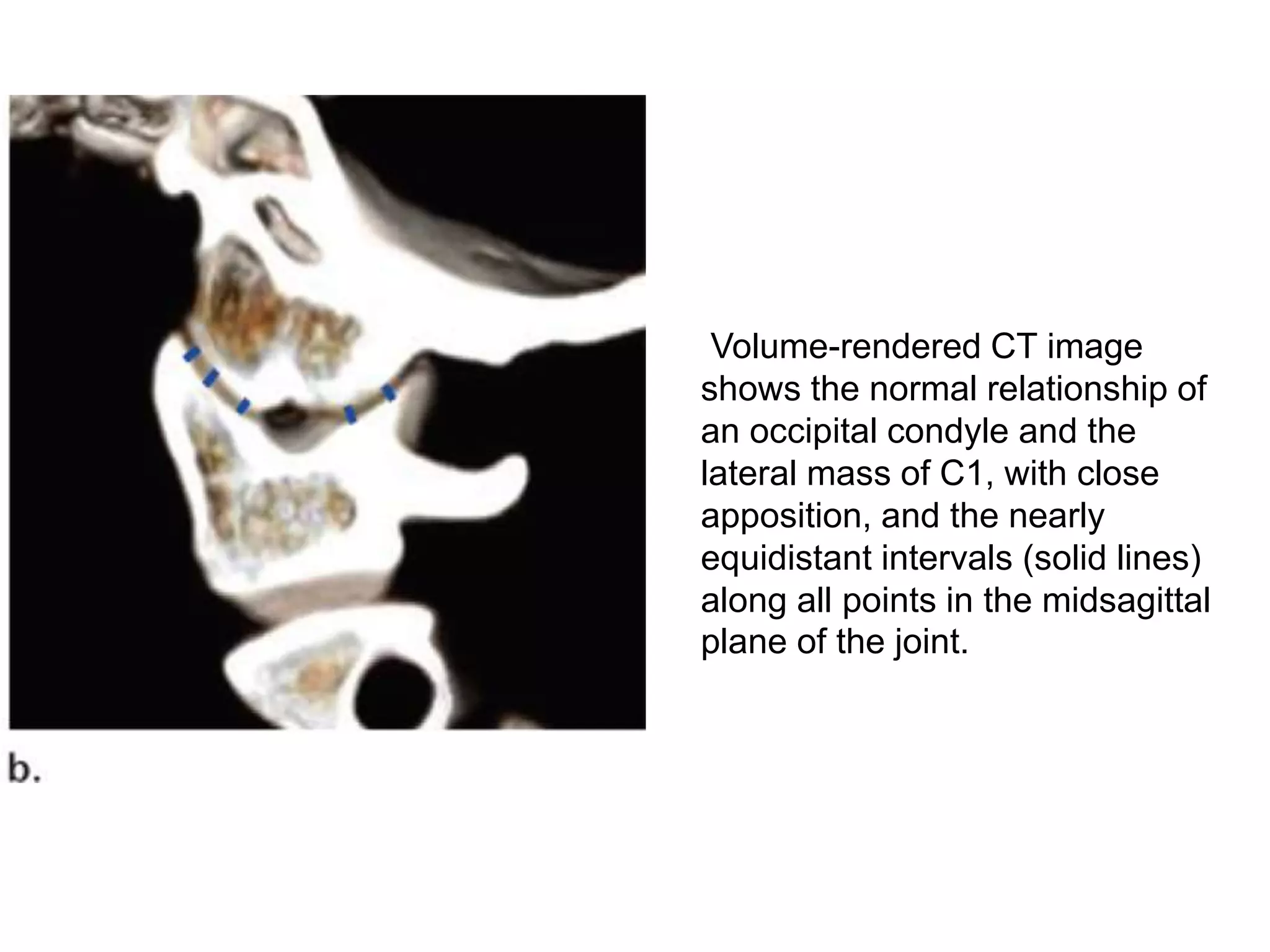 CT Cervical Spine | PPTX