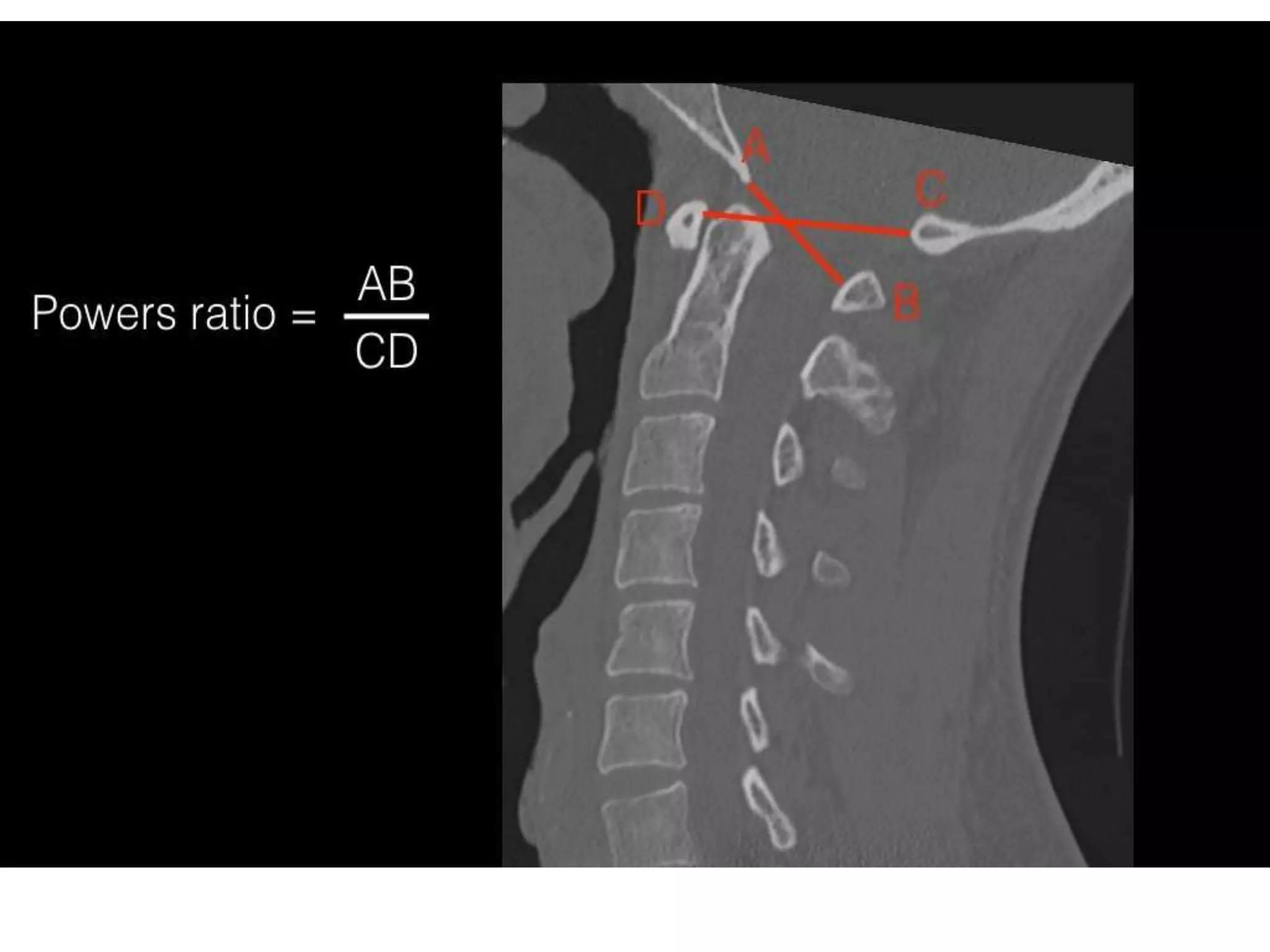 CT Cervical Spine | PPTX