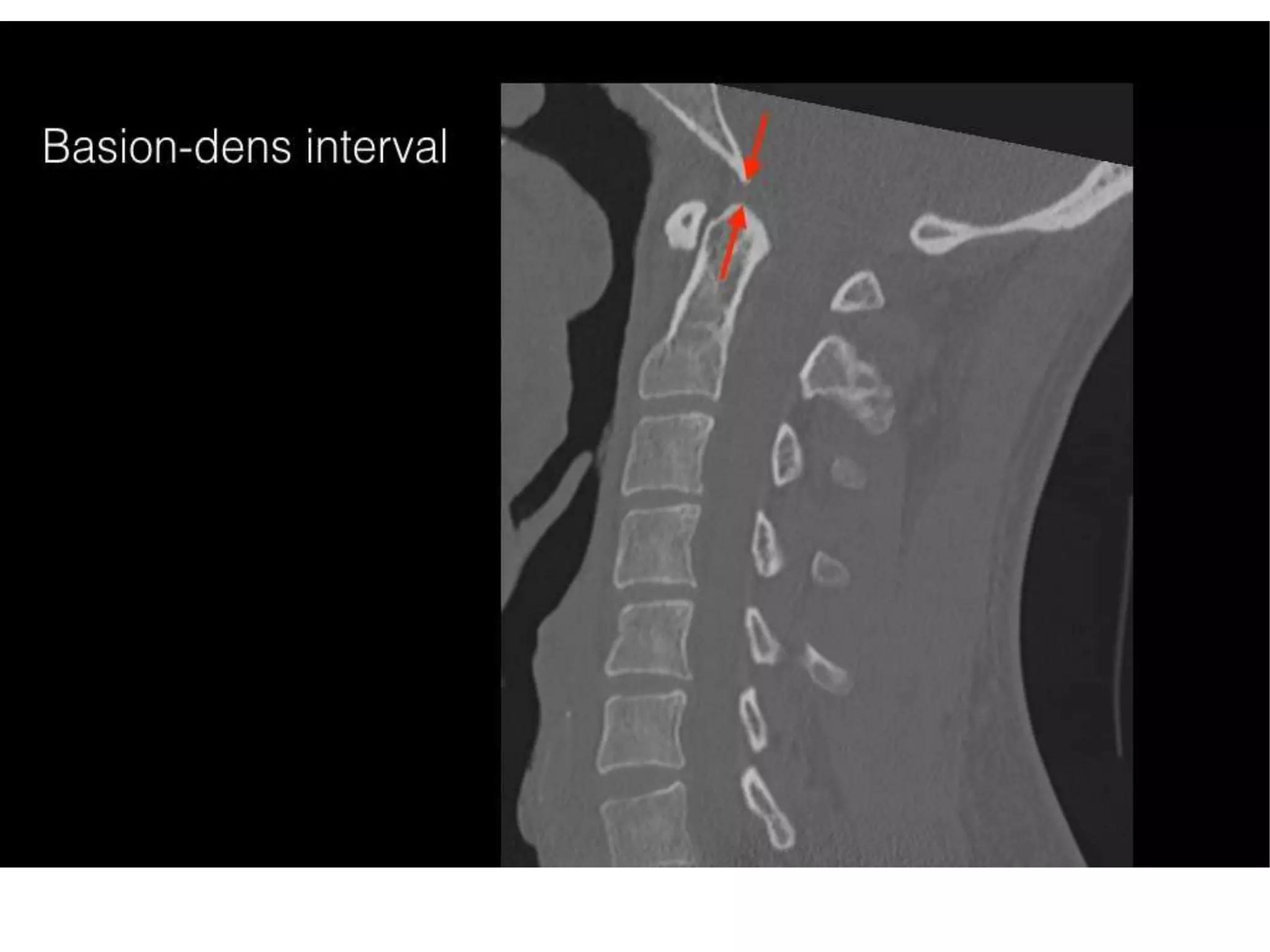 CT Cervical Spine | PPTX