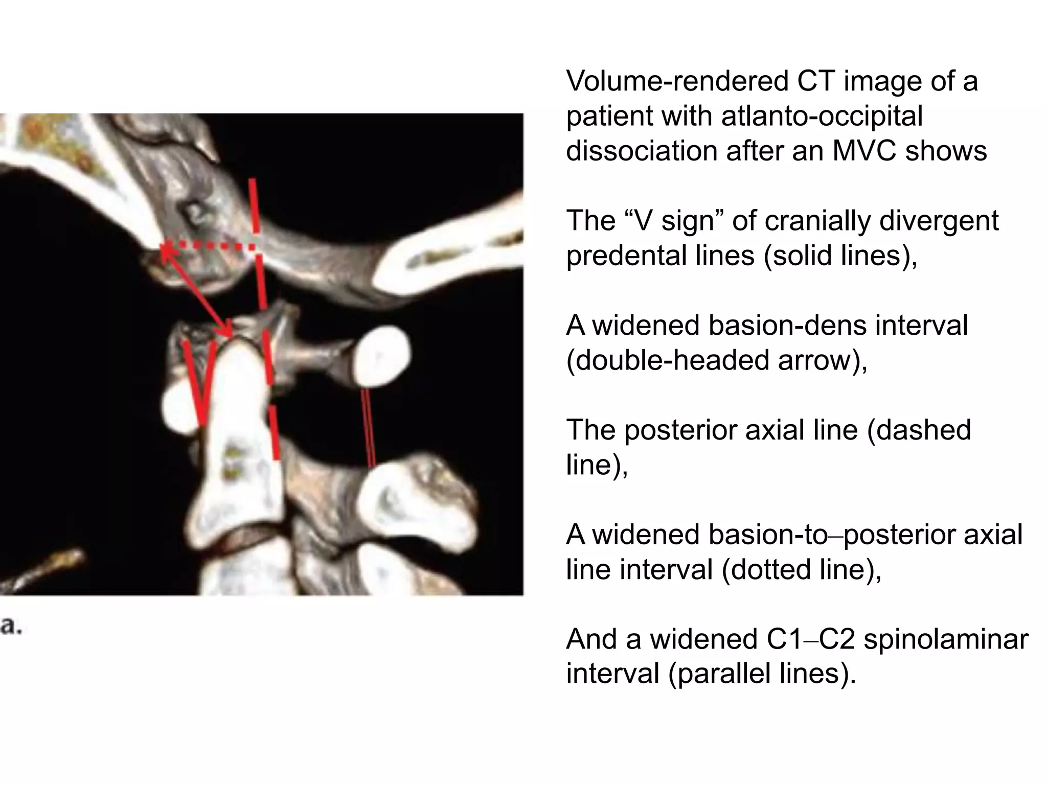 CT Cervical Spine | PPTX