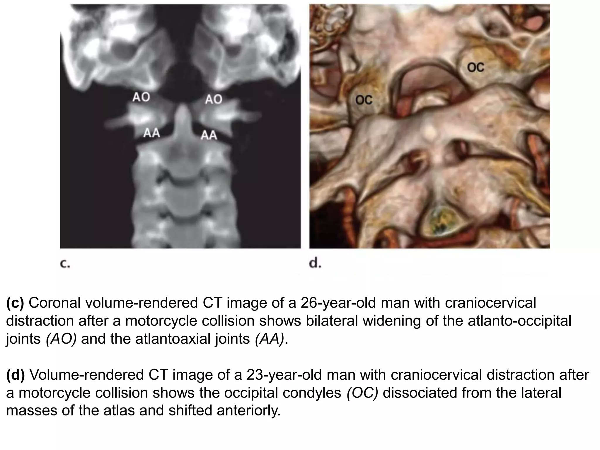 CT Cervical Spine | PPTX