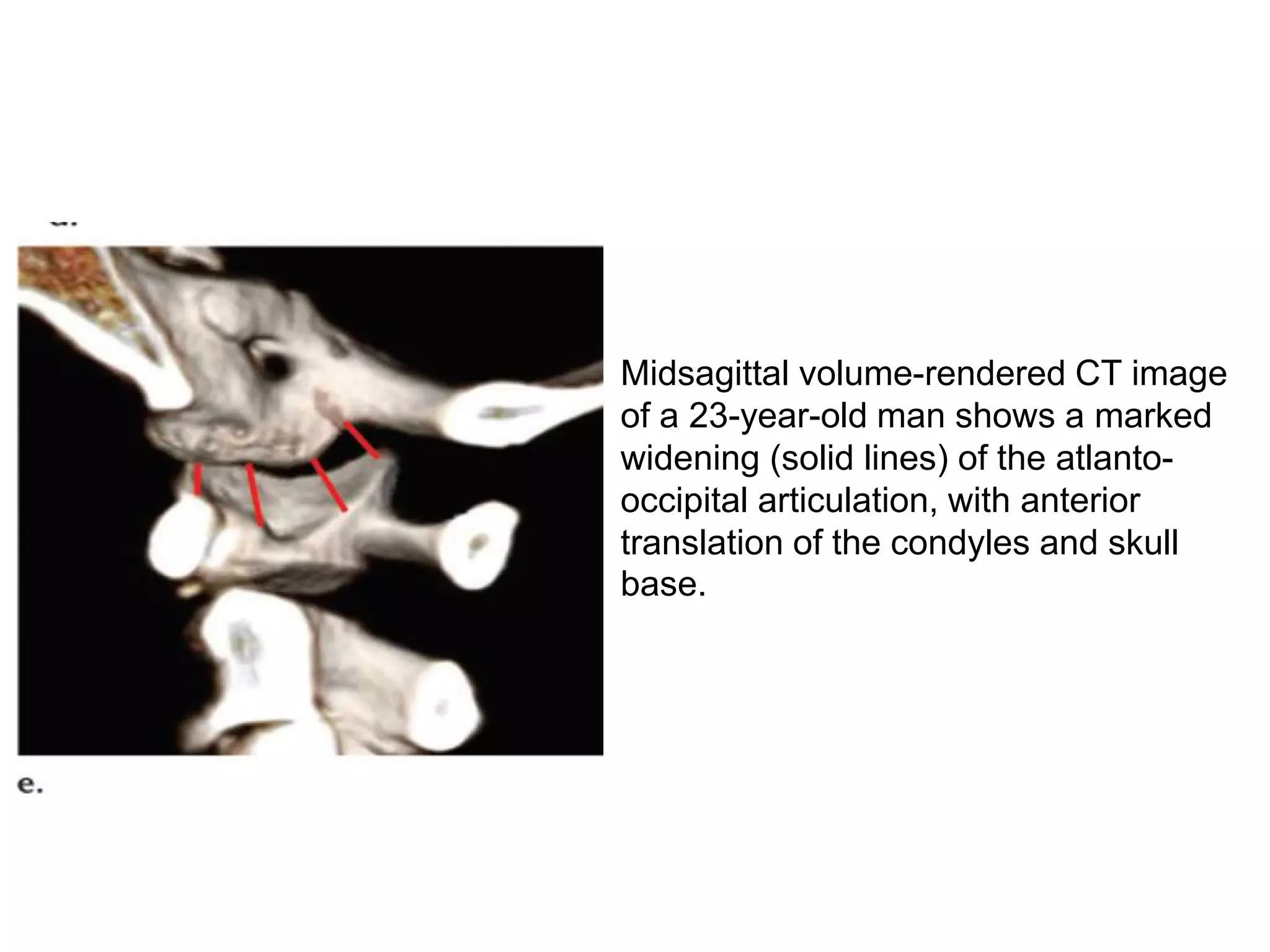 CT Cervical Spine | PPTX