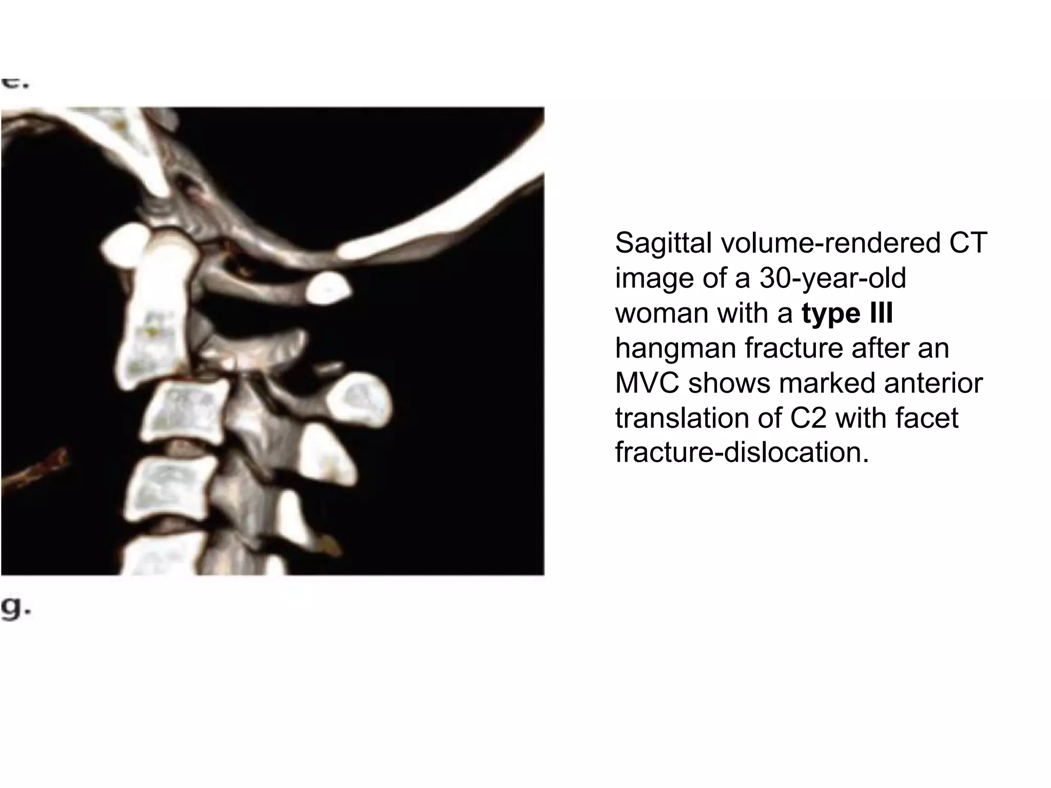 CT Cervical Spine | PPTX