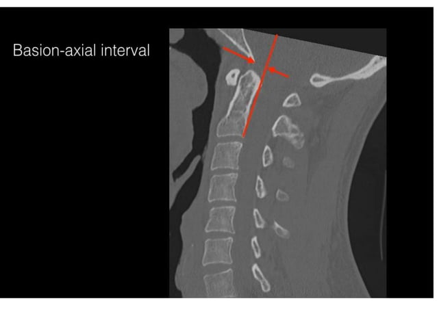 CT Cervical Spine | PPTX