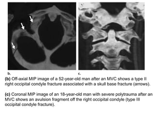 CT Cervical Spine | PPTX