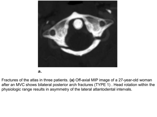 CT Cervical Spine | PPTX