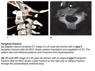 CT Cervical Spine | PPTX