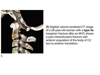 CT Cervical Spine | PPTX