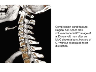 CT Cervical Spine | PPTX