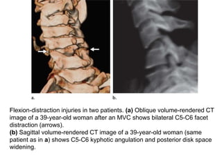 CT Cervical Spine | PPTX