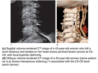 CT Cervical Spine | PPTX