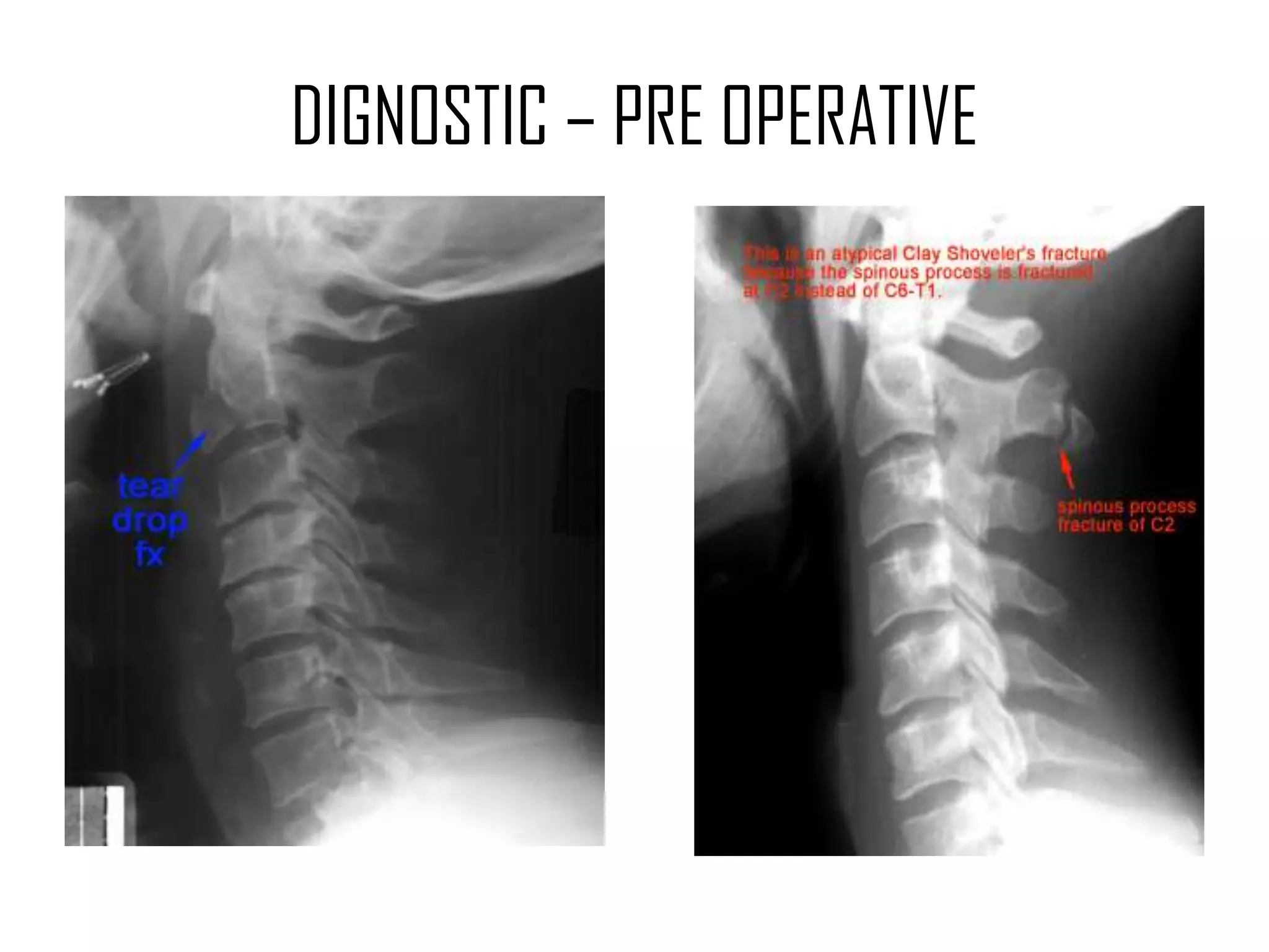 Cervical Fractures and Cervical spine injuries - Dr.KK