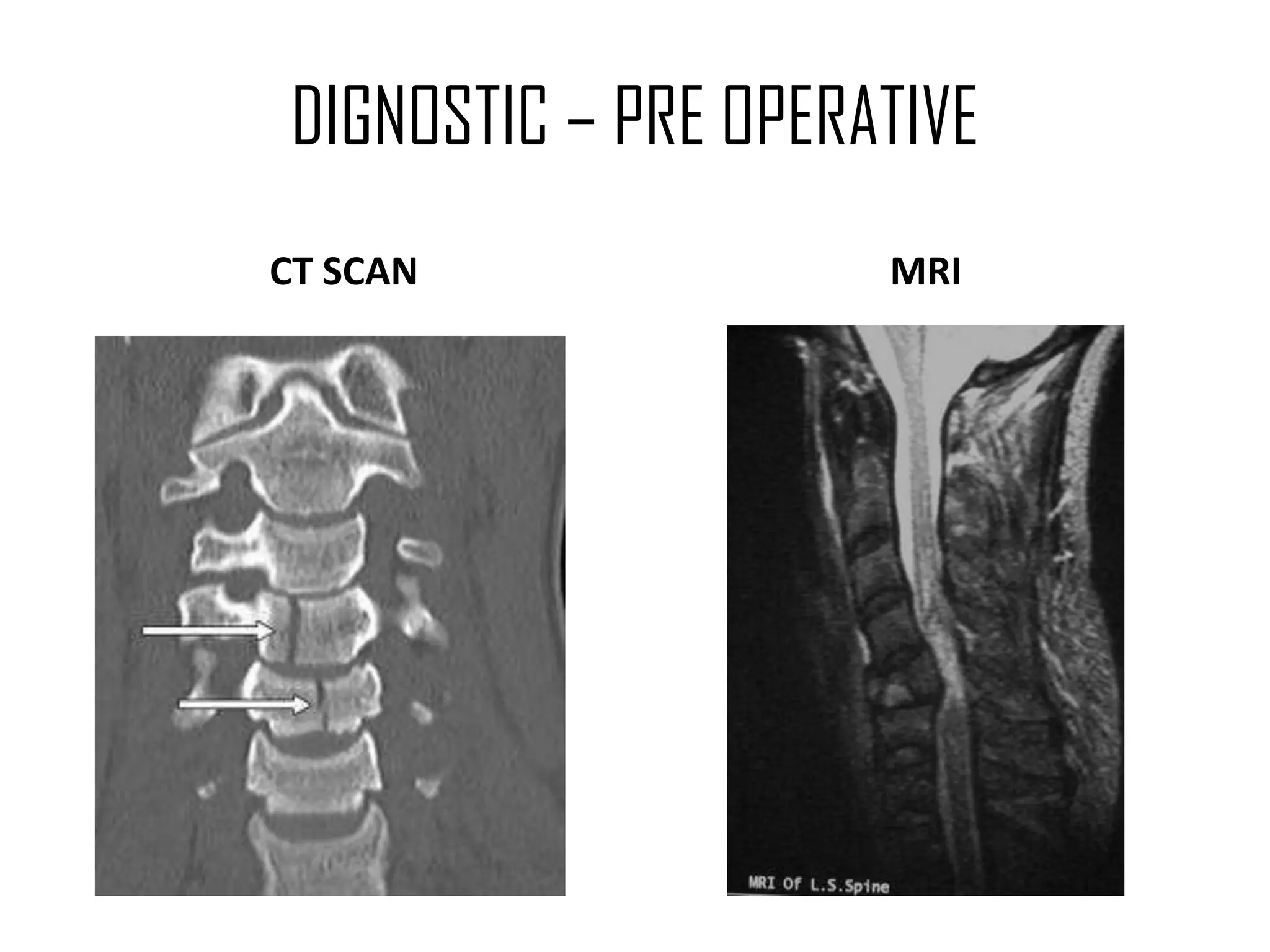Cervical Fractures and Cervical spine injuries - Dr.KK
