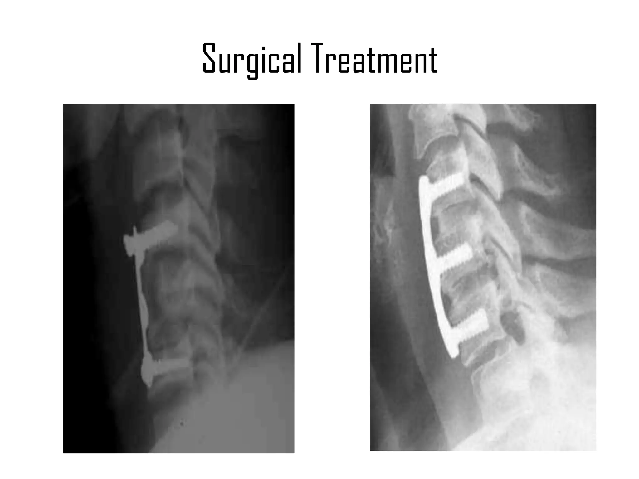 Cervical Fractures and Cervical spine injuries - Dr.KK