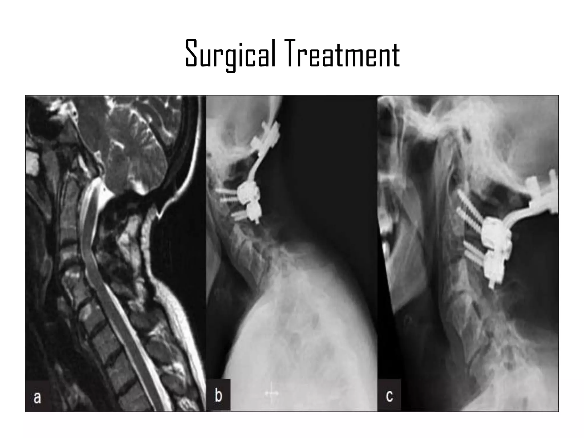 Cervical Fractures and Cervical spine injuries - Dr.KK