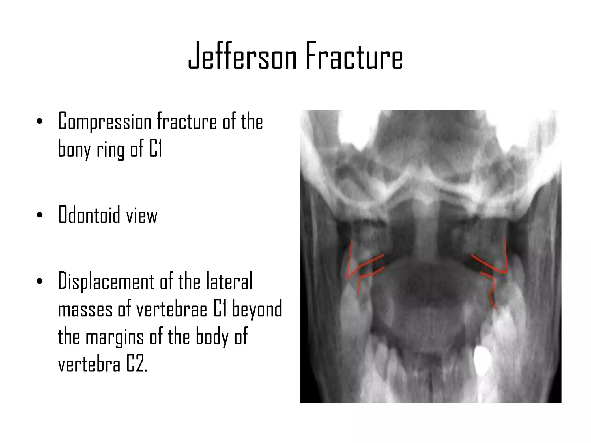 Cervical Fractures and Cervical spine injuries - Dr.KK