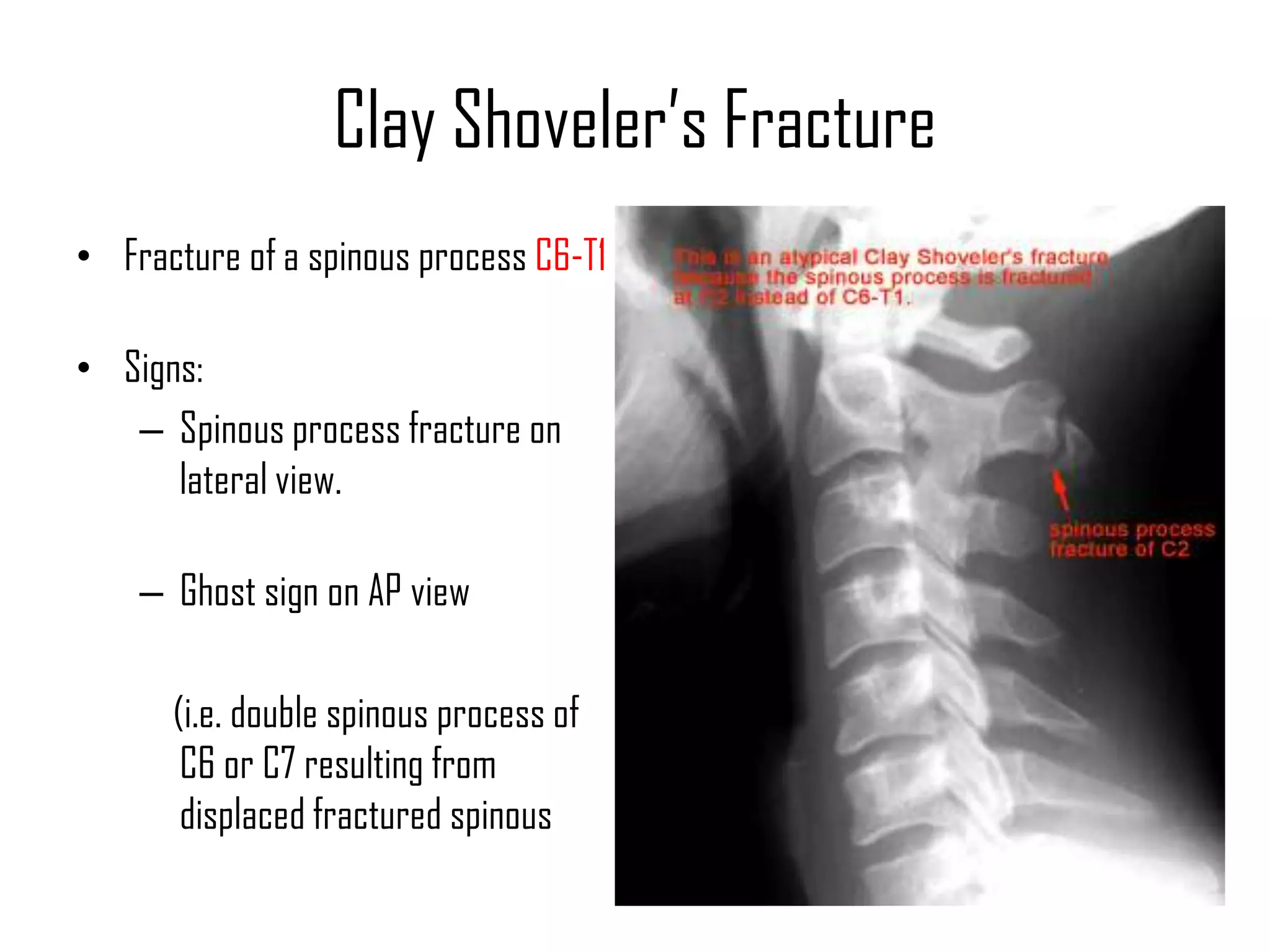 Cervical Fractures and Cervical spine injuries - Dr.KK