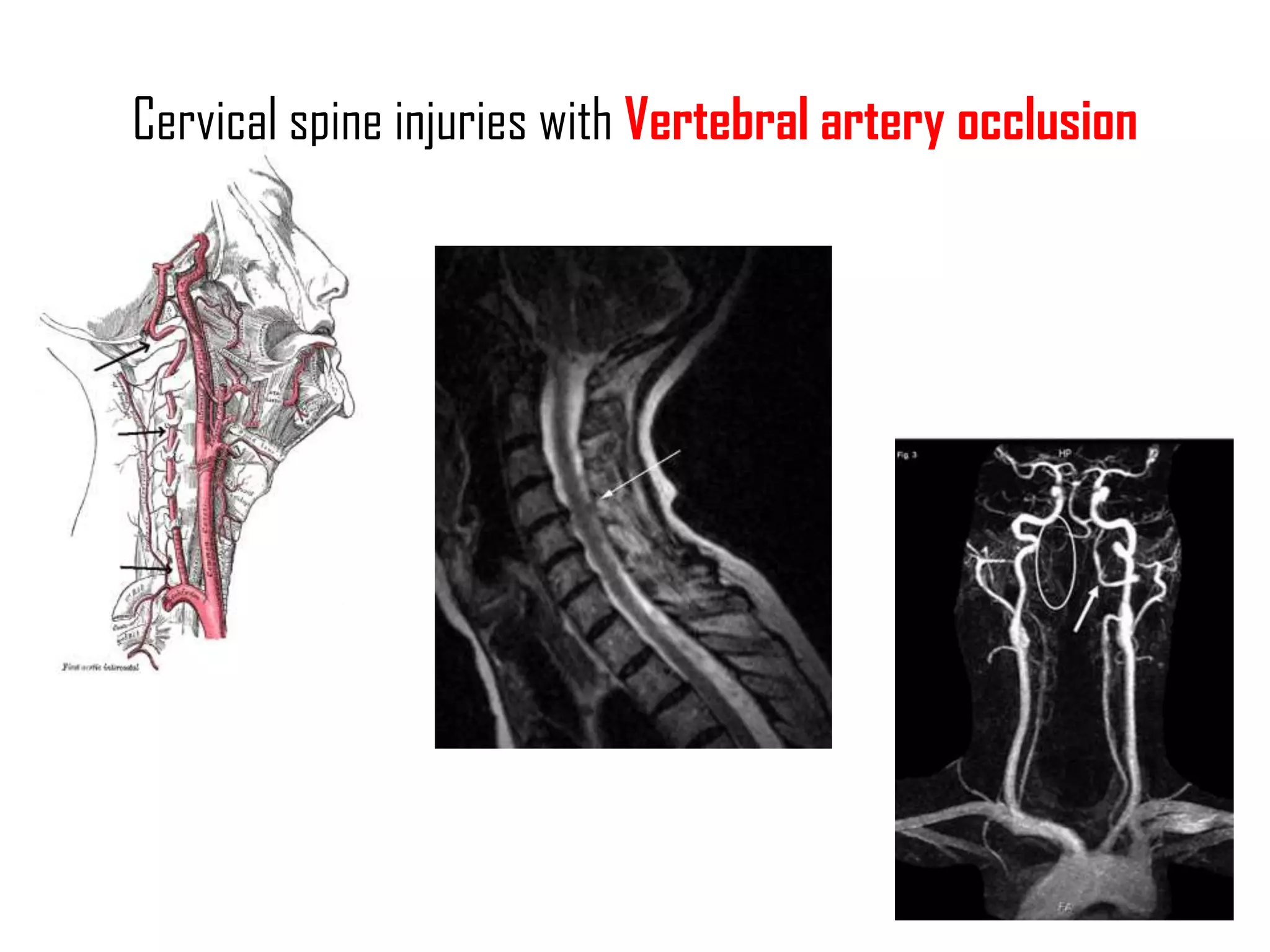 Cervical Fractures and Cervical spine injuries - Dr.KK