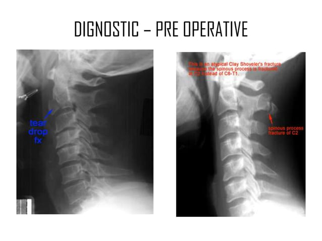 Cervical Fractures and Cervical spine injuries - Dr.KK