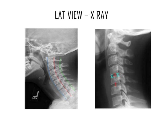 Cervical Fractures and Cervical spine injuries - Dr.KK