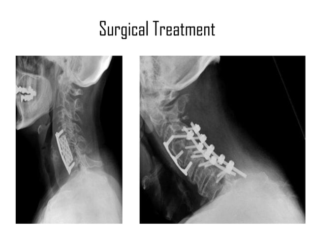 Cervical Fractures and Cervical spine injuries - Dr.KK