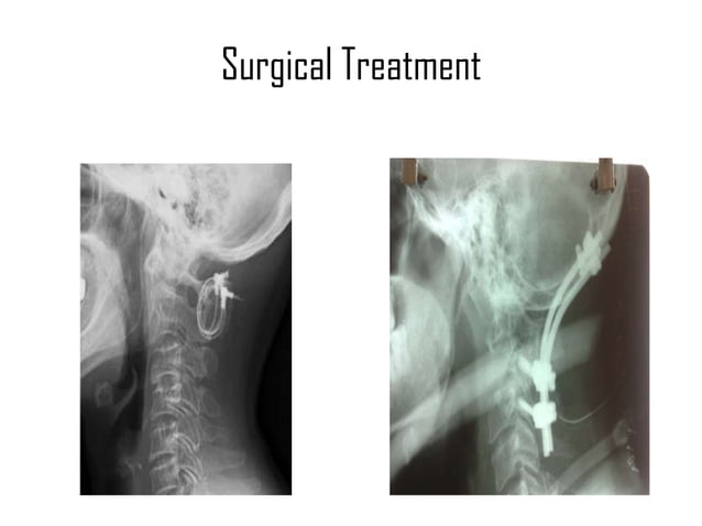 Cervical Fractures and Cervical spine injuries - Dr.KK