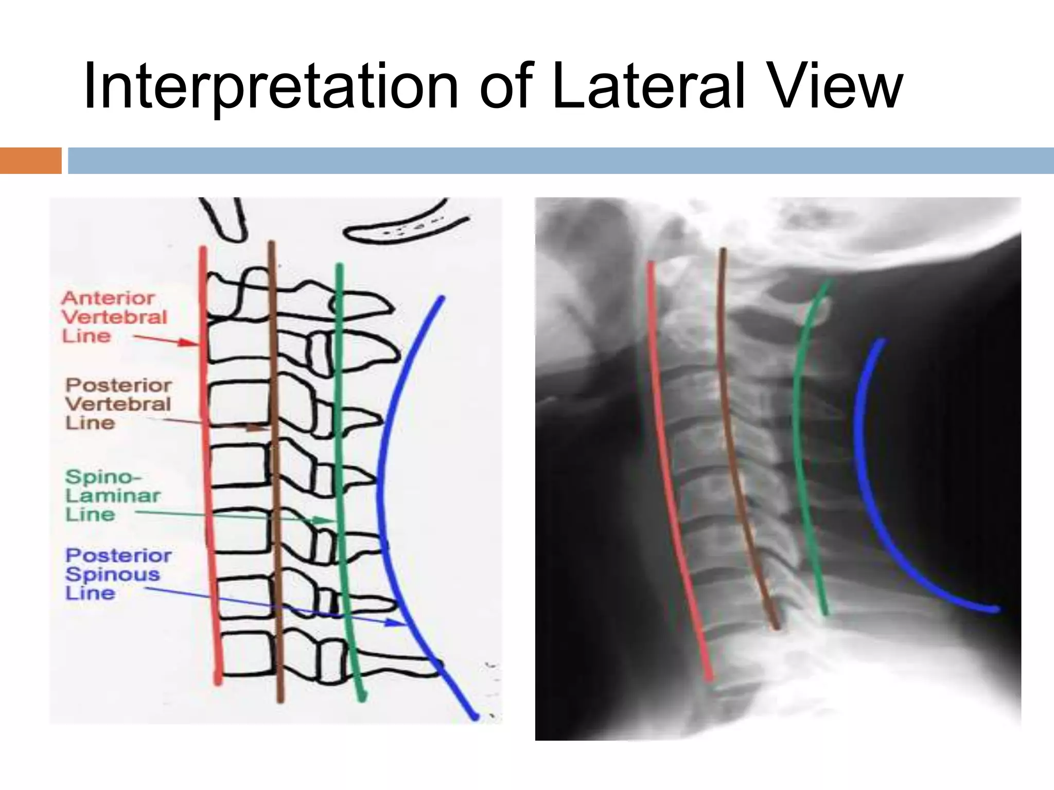C spine positioning | PPTX
