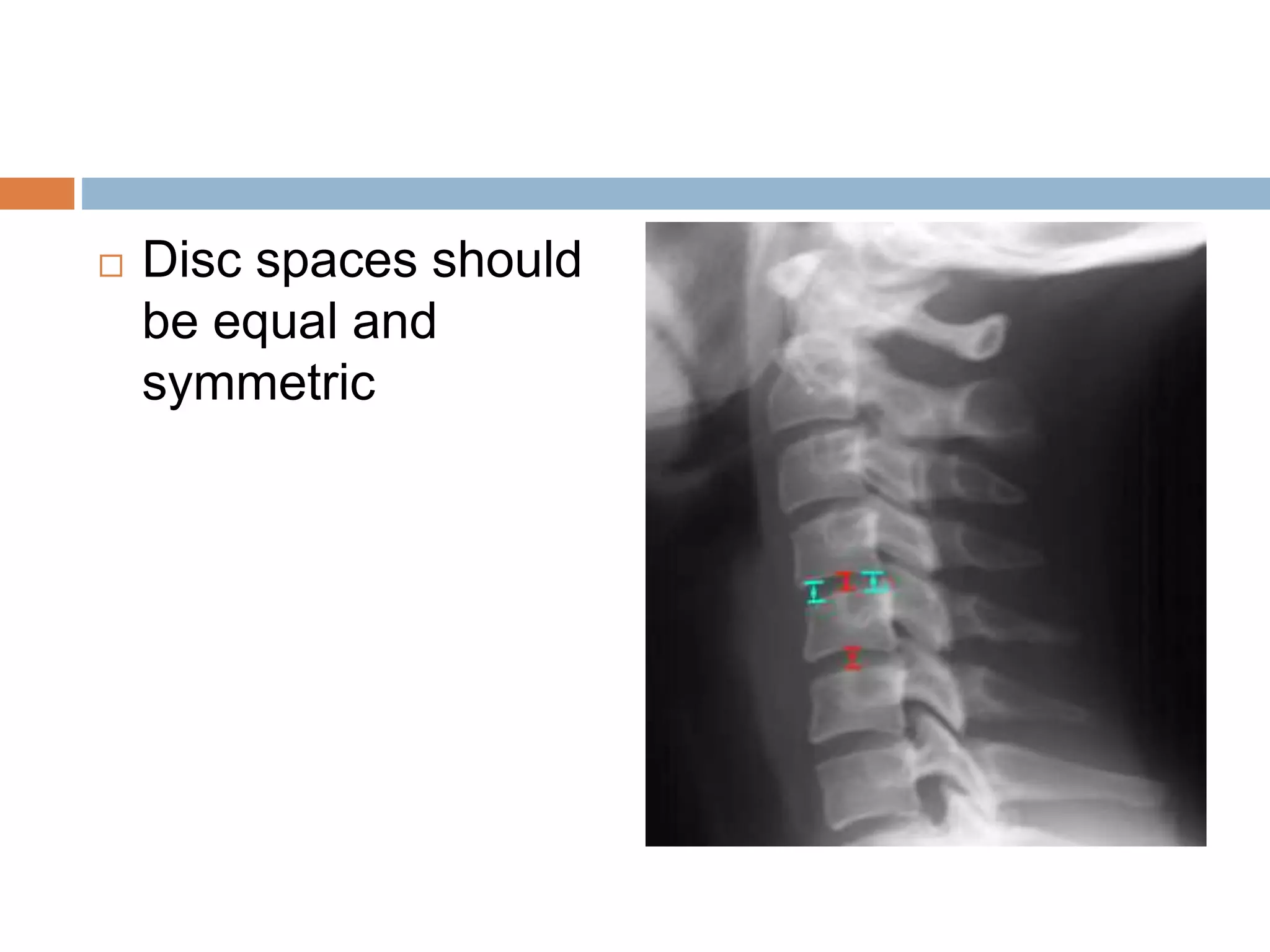C spine positioning | PPTX