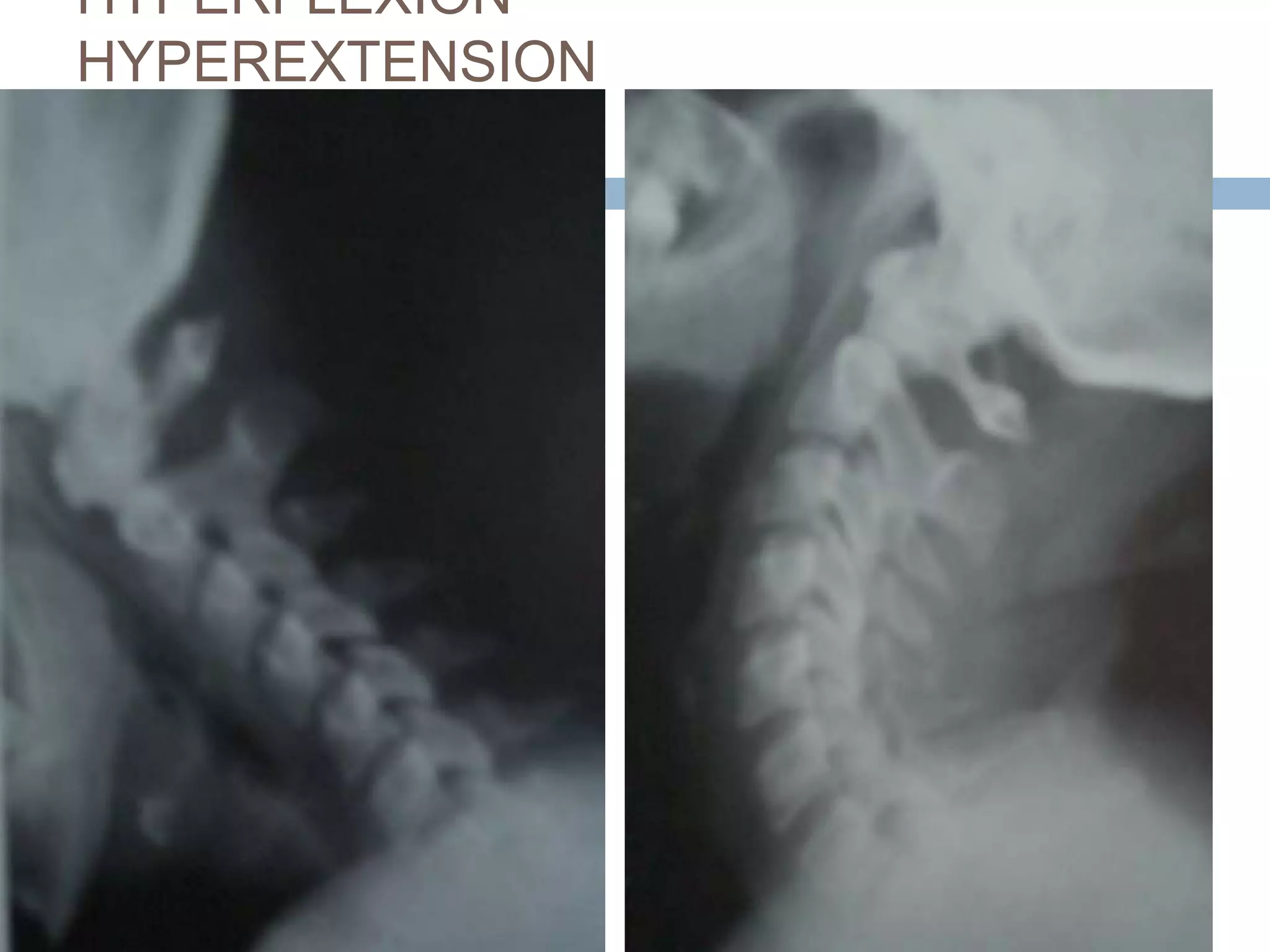 C spine positioning | PPTX