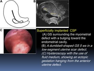 Update on Treatment of Cesarean Scar Pregnancy | PPT
