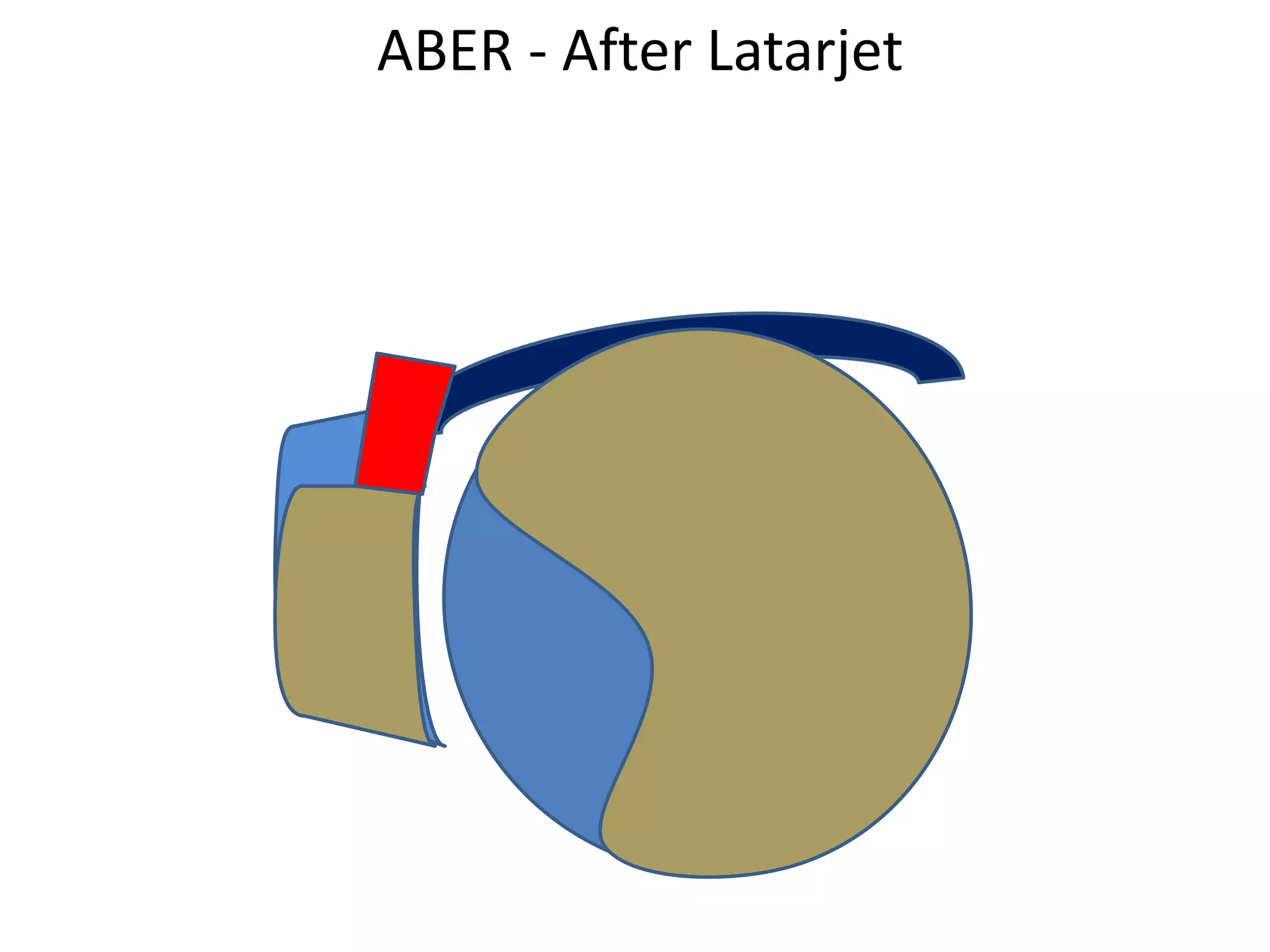 Latarjet – the panacea for traumatic anterior shoulder | PPTX