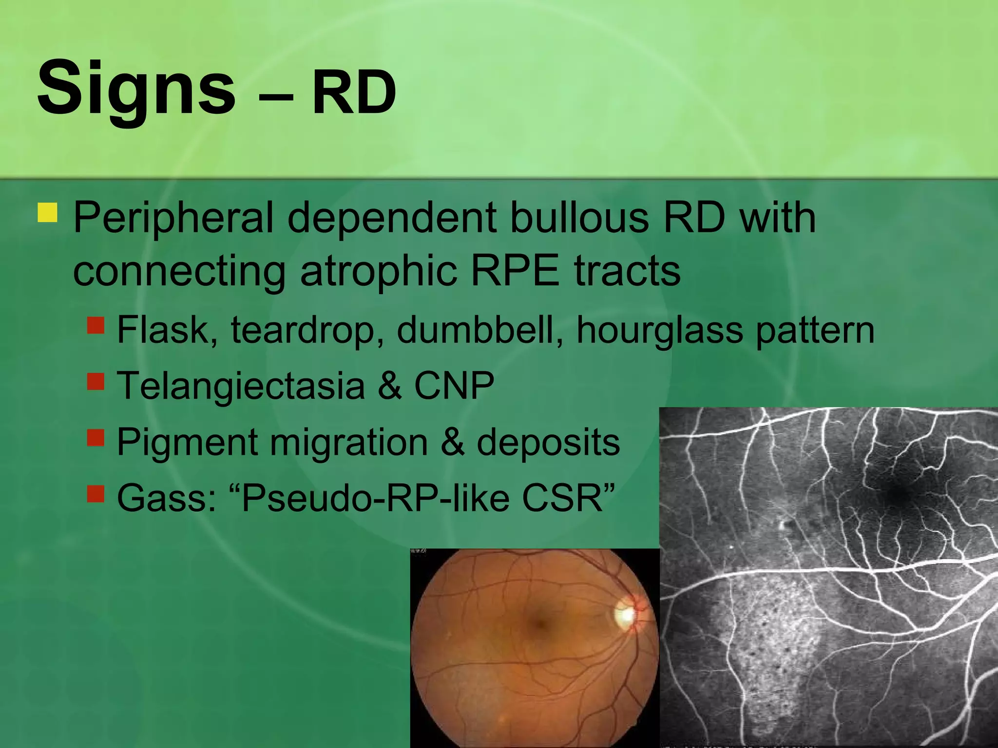 Central Serous Retinopathy | PPT