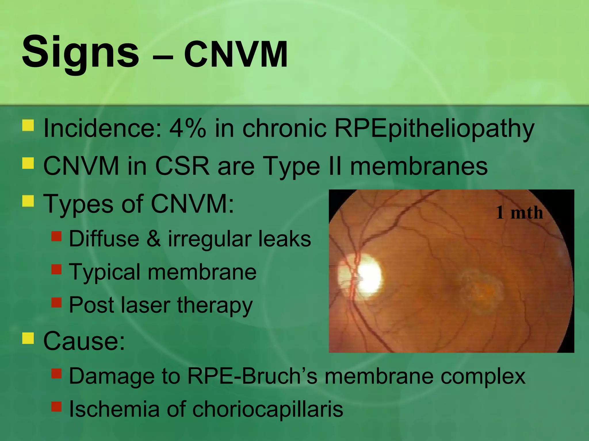 Central Serous Retinopathy | PPT