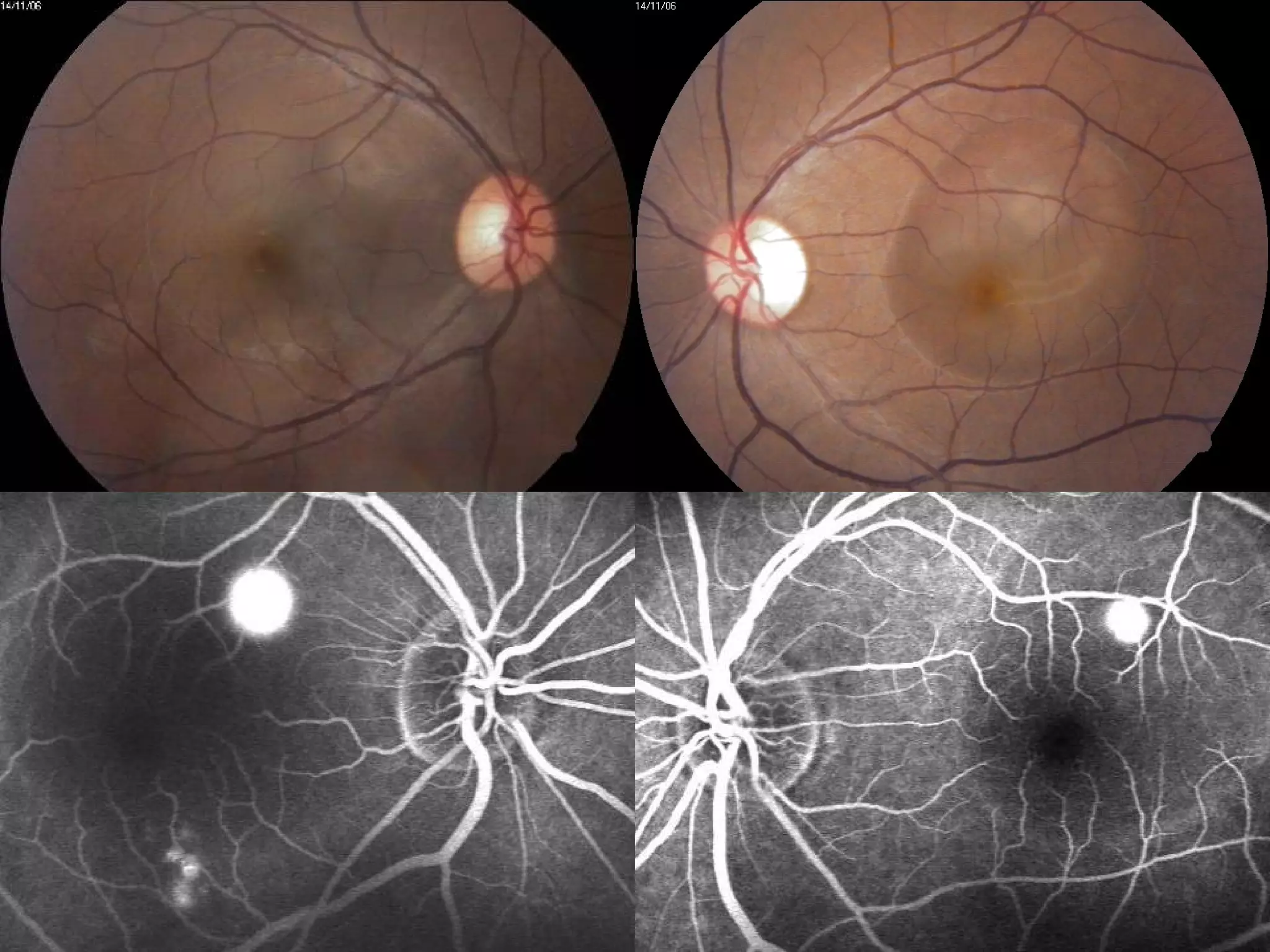 Central Serous Retinopathy | PPT