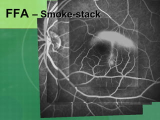 Central Serous Retinopathy Smokestack