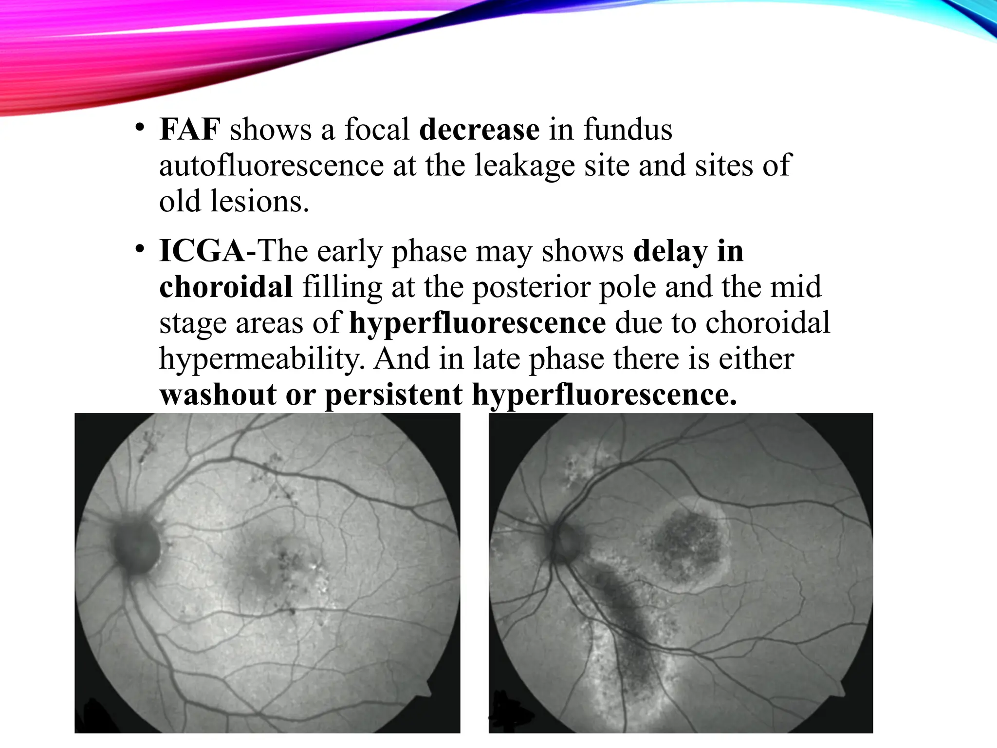CSR central serous chorioretinopathy car | PPTX