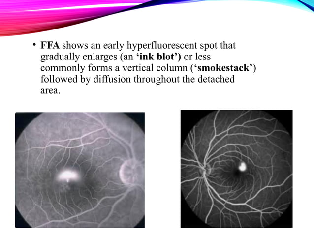 CSR central serous chorioretinopathy car | PPT